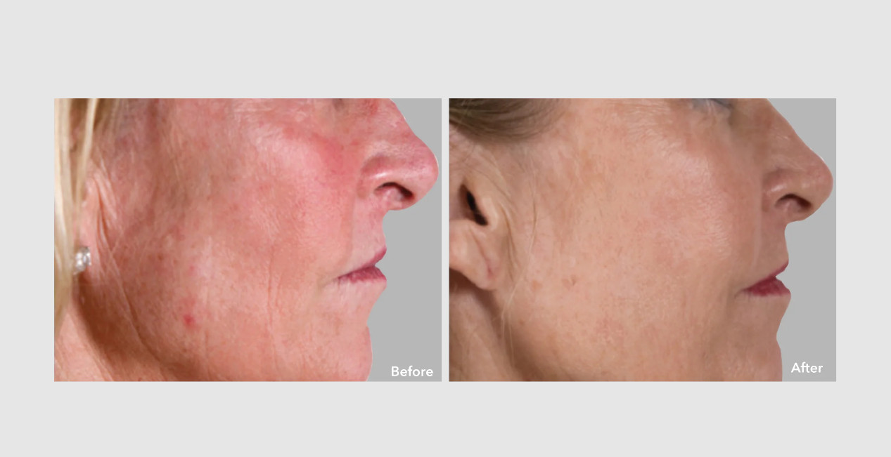 AnteAGE MD System Serum and Accelerator - Bộ đôi chống lão hoá cân bằng ...