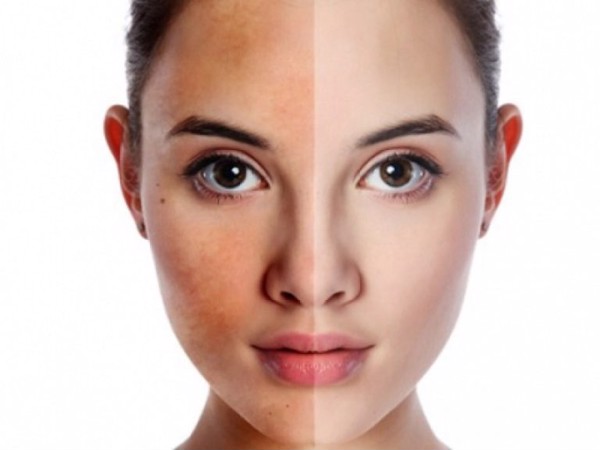 Da sạm màu do những nguyên nhân nào?