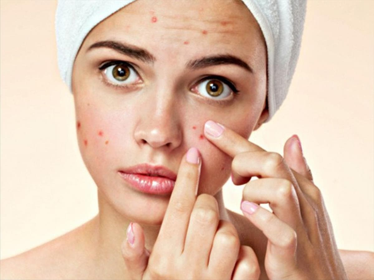 Cách trị da mặt nhờn, mụn với dung dịch Image I peel Acne Lift