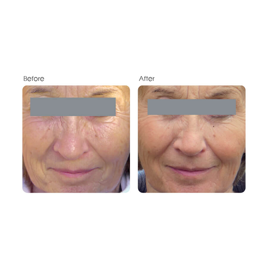 Md Ceuticals Md:Complex Genx Mimetic Peptide & Growth Factors – Tiêm tế ...